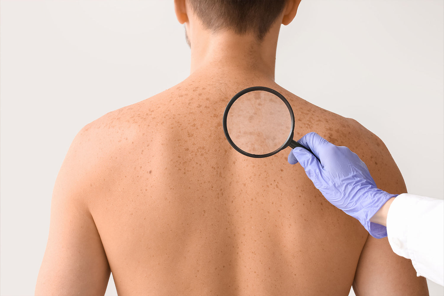 Skin Cancer: How to Examine Your Own Skin – PhysioTru